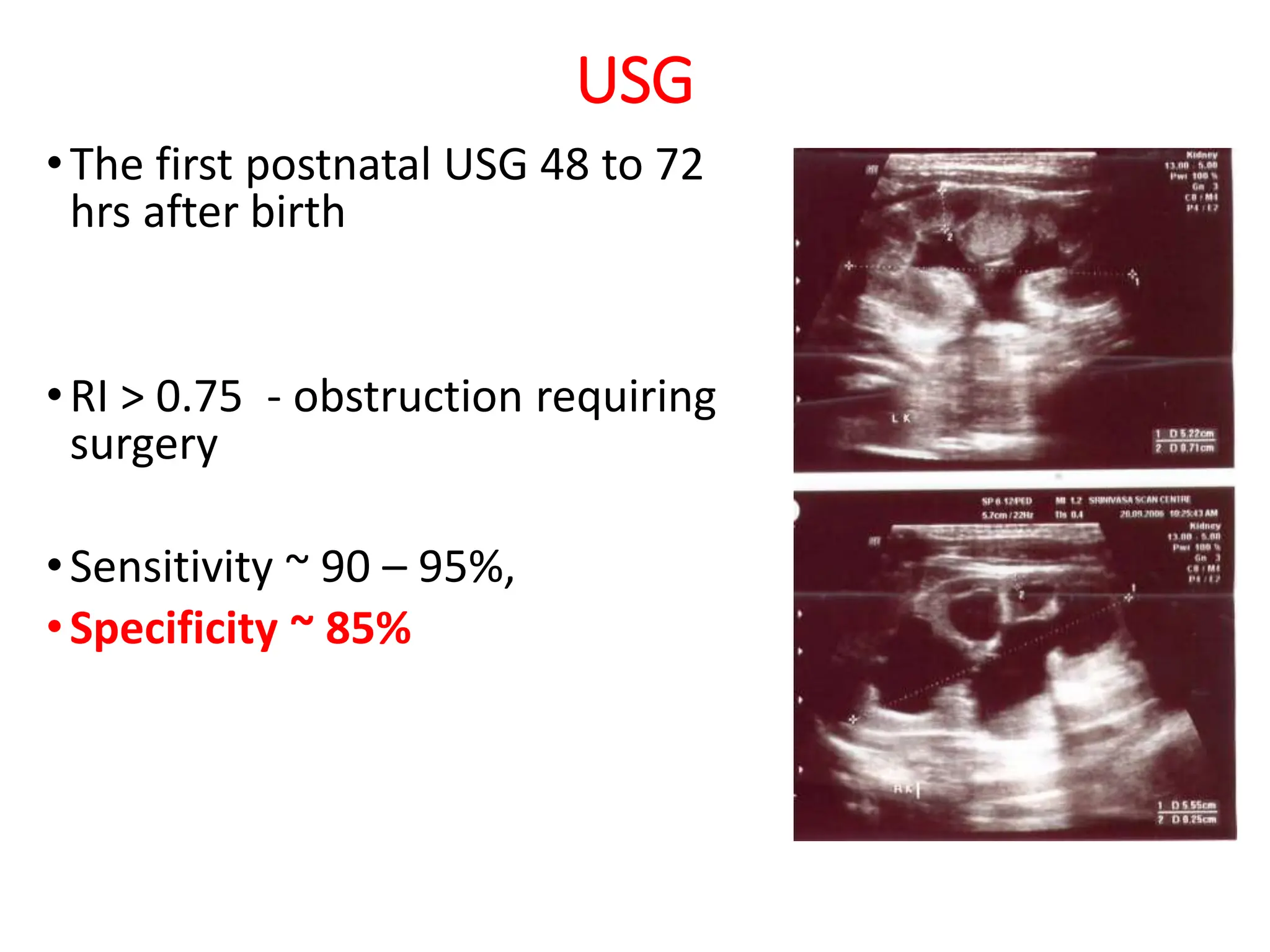 Pelvi-ureteric junction obstruction | PPTX