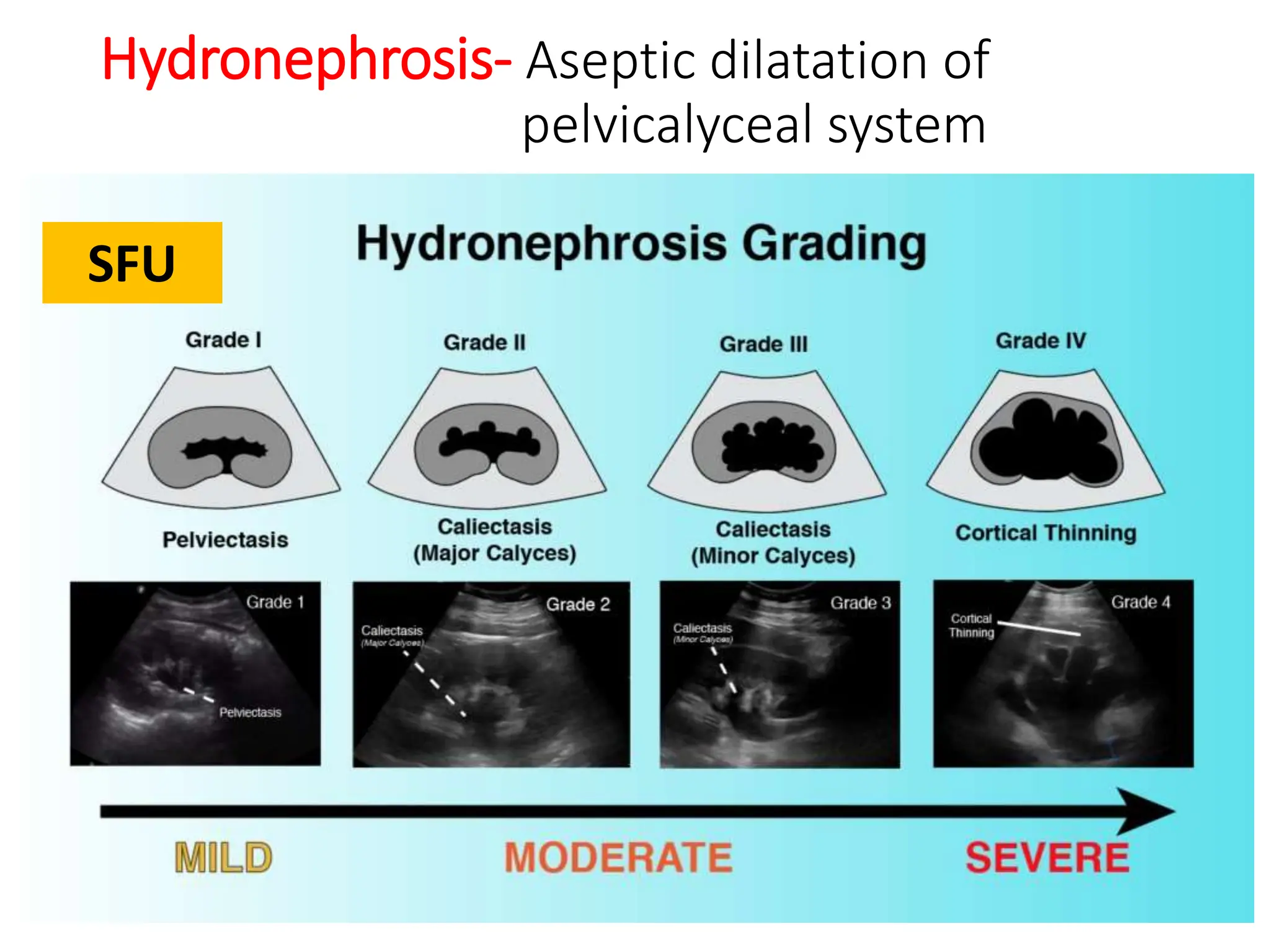 Pelvi-ureteric junction obstruction | PPTX