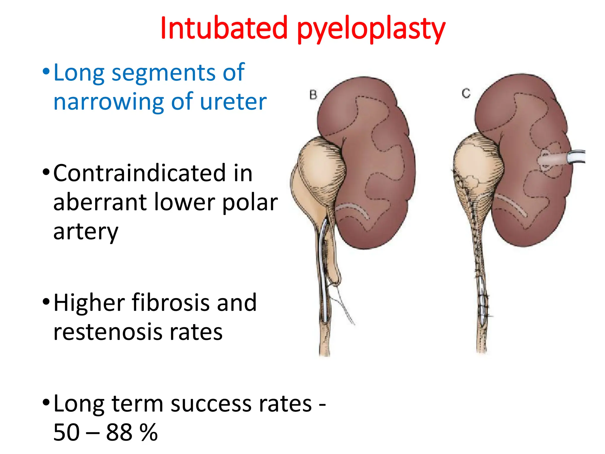 Pelvi-ureteric junction obstruction | PPTX