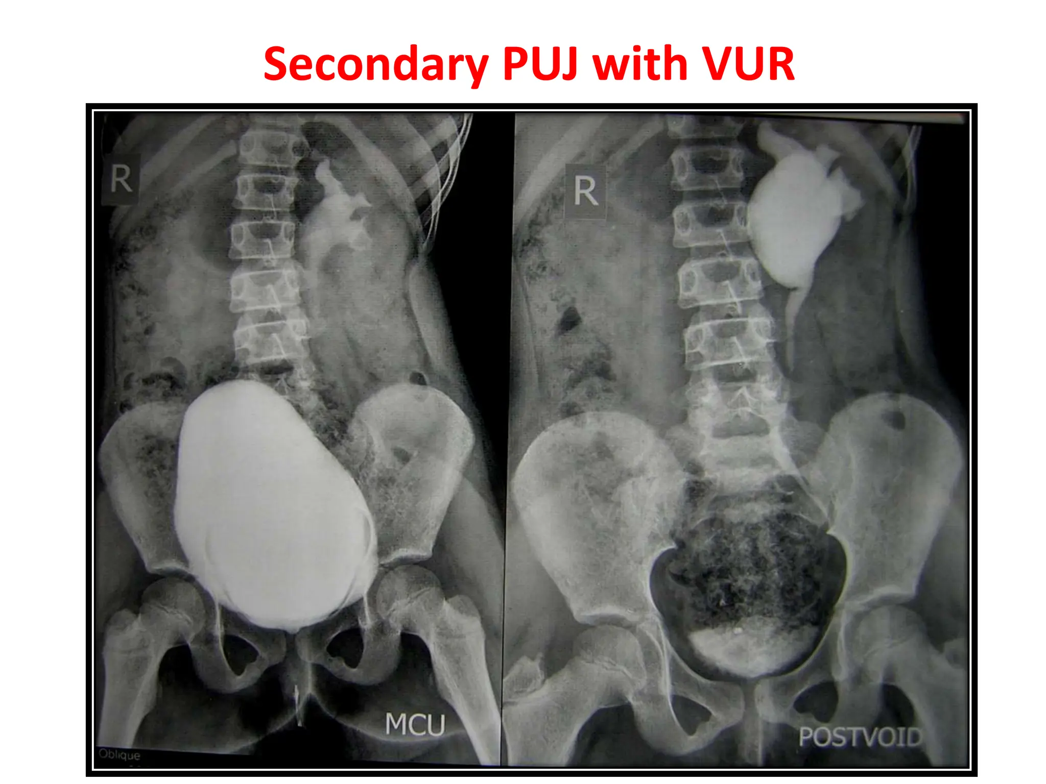 Pelvi-ureteric junction obstruction | PPTX