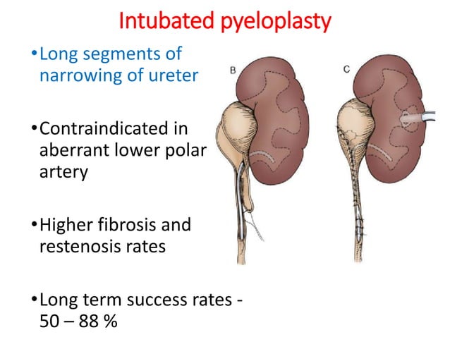 Pelvi-ureteric junction obstruction | PPTX | Digestive Disorders ...