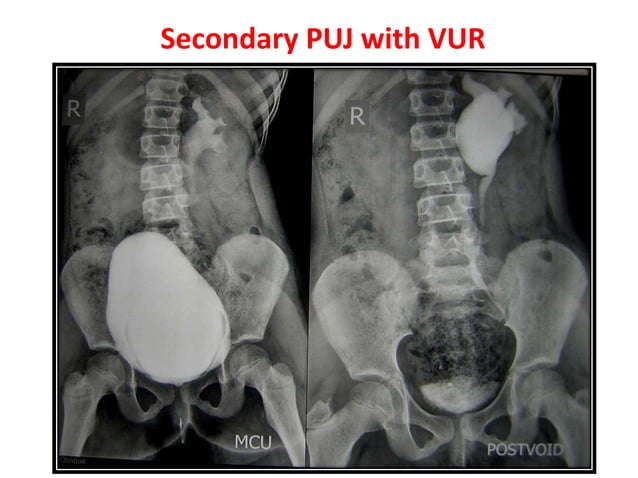 Pelvi-ureteric junction obstruction | PPTX | Digestive Disorders ...