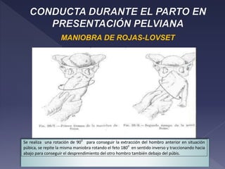 Parto en pelviano | PPTX
