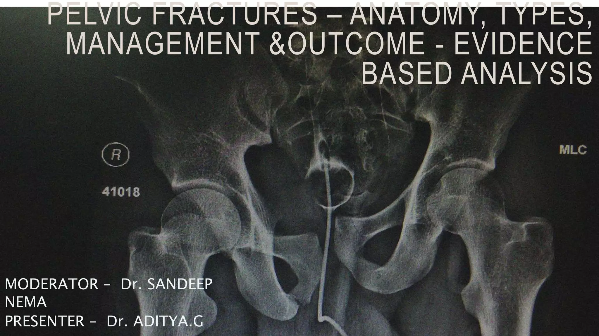 PELVIC FRACTURES – ANATOMY, TYPES, MANAGEMENT &OUTCOME - EVIDENCE BASED ...