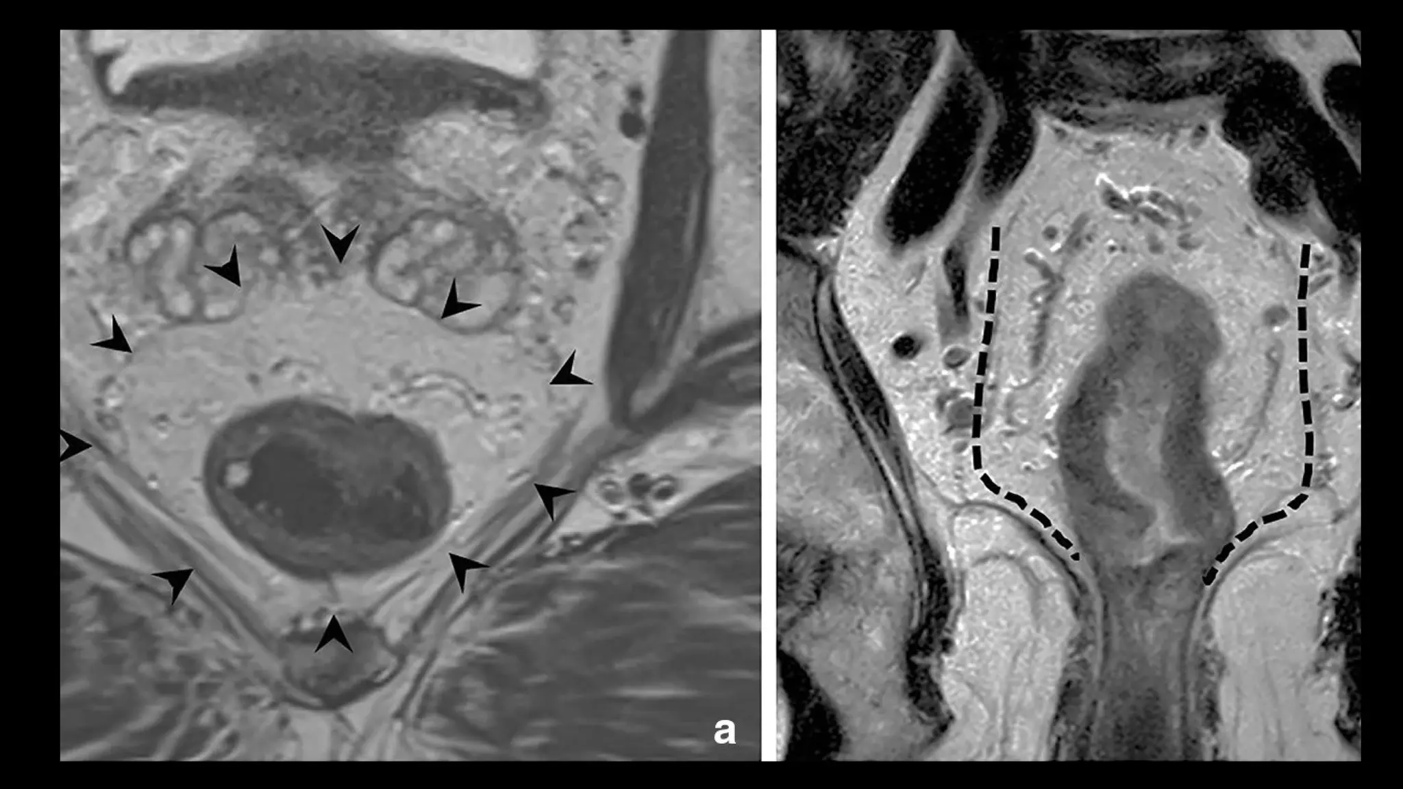 Pelvic Anatomy Mri Of Male And Female Pelvispptx 9323