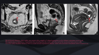 Pelvic anatomy MRI OF MALE AND FEMALE PELVIS.pptx