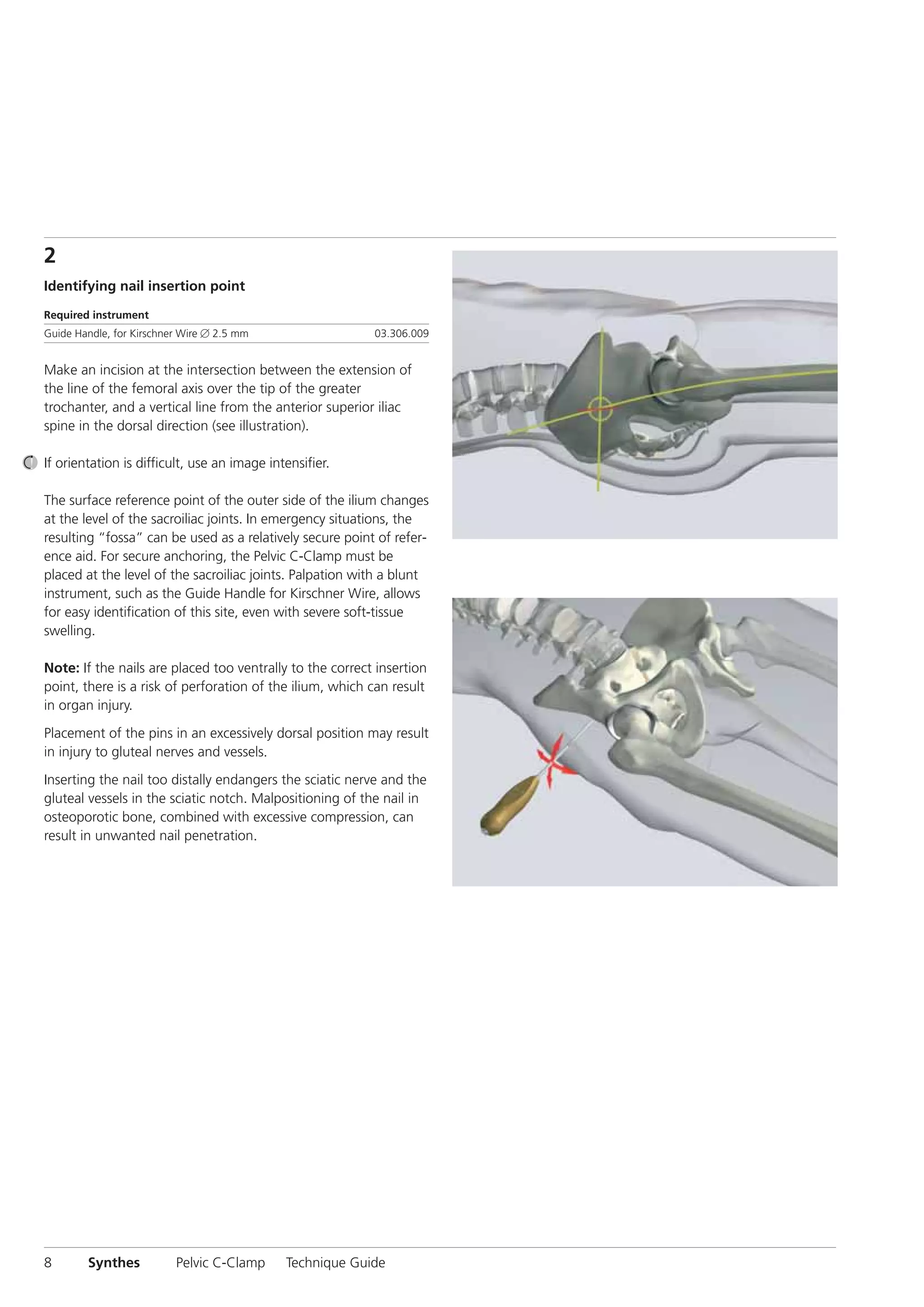 Pelvic c clamp | PDF