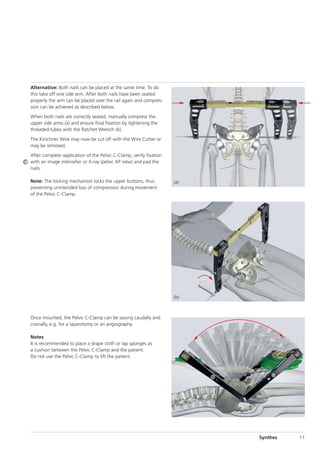 Pelvic c clamp | PDF