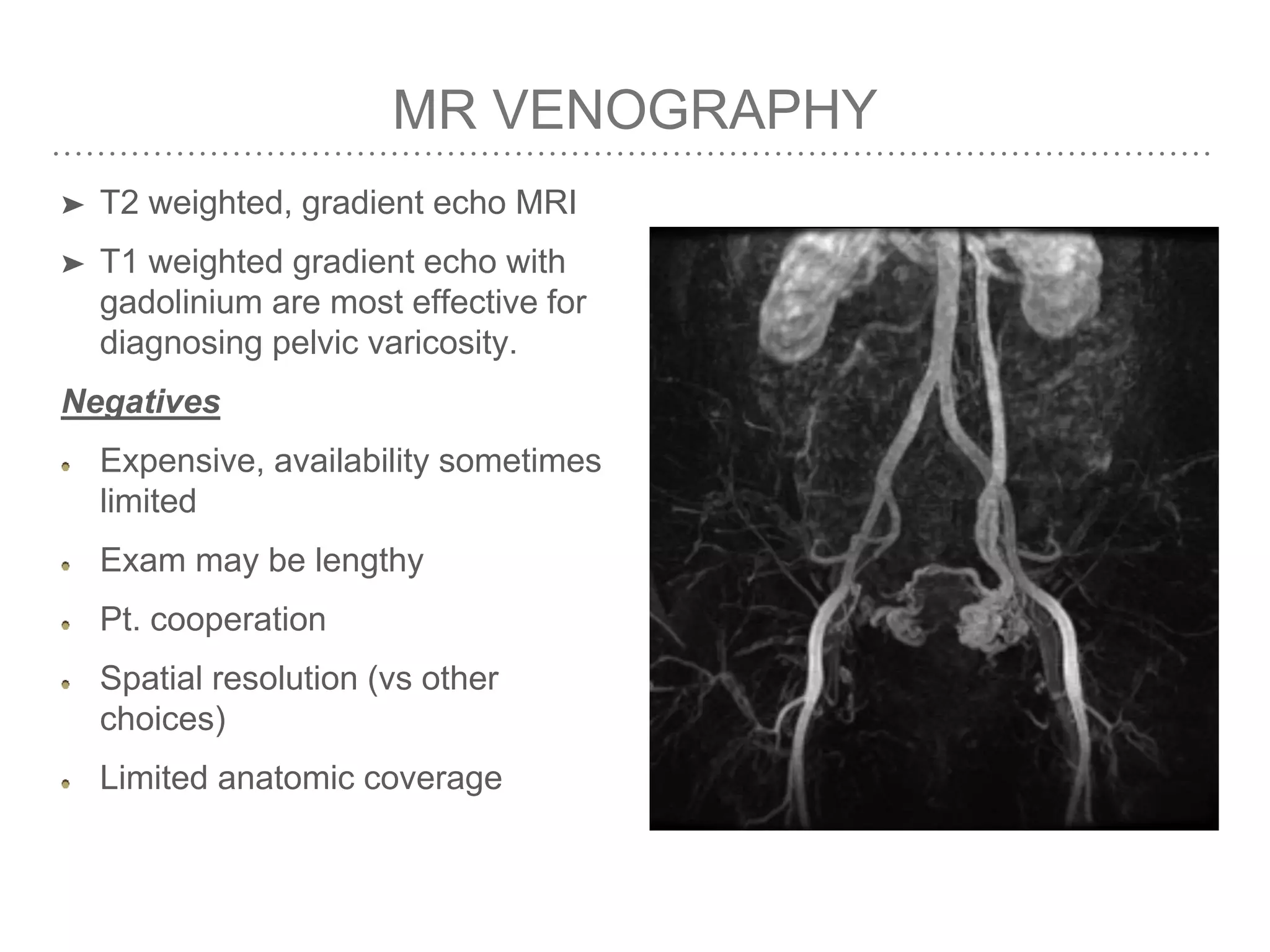 Pelvic Congestion Syndrome | PPTX