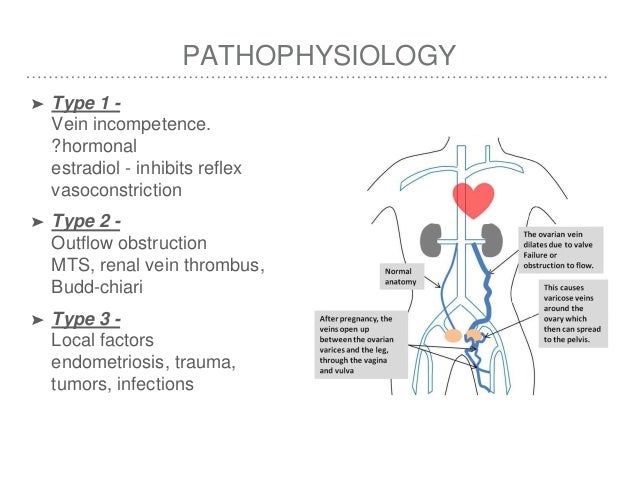 Pelvic Congestion Syndrome