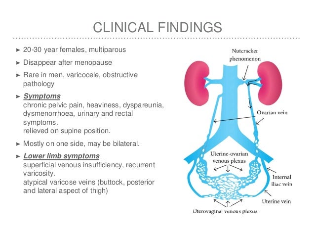 Pelvic Congestion Syndrome