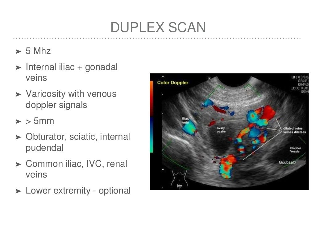 Pelvic Congestion Syndrome