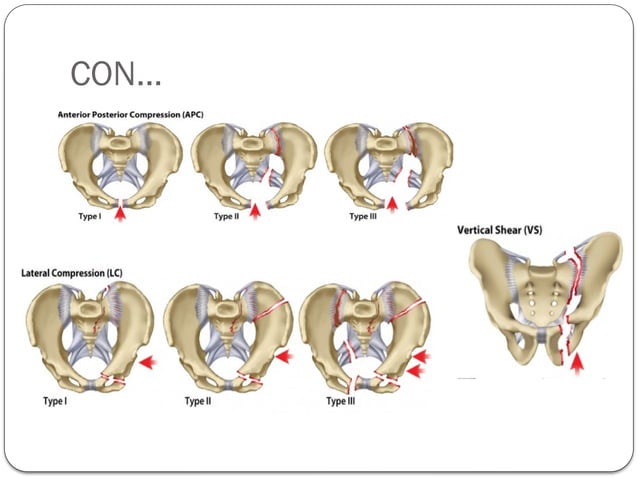 Pelvic Ring disruption and Principle of management | PPT