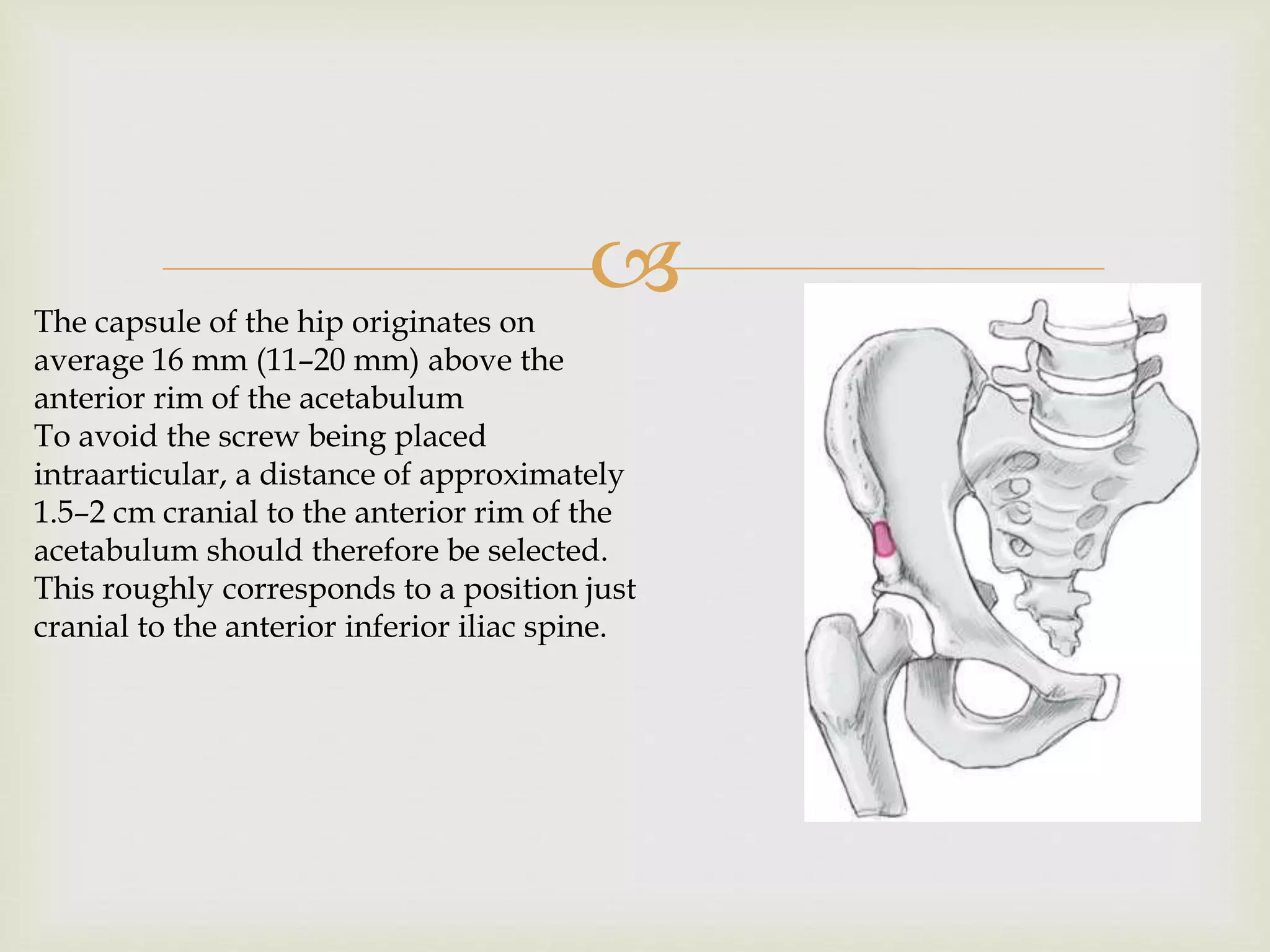 Pelvic ex fix | PPTX
