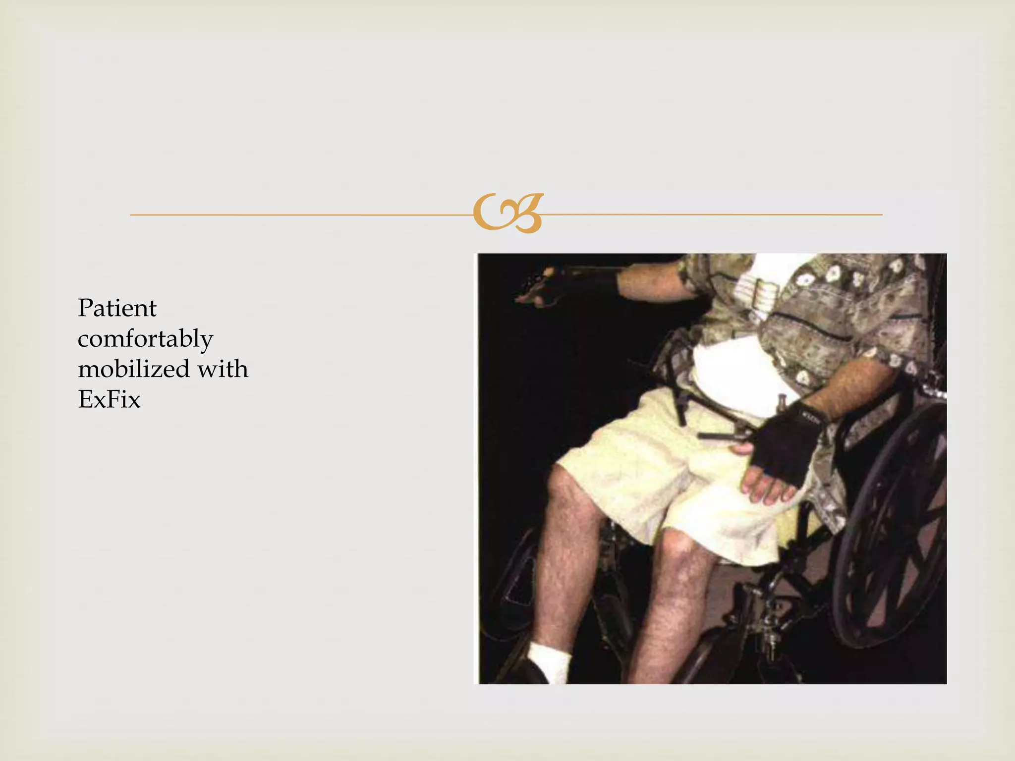 Pelvic ex fix | PPTX