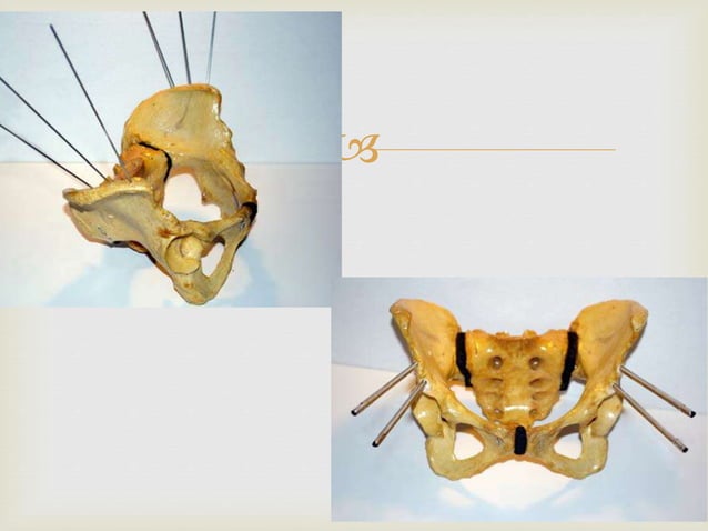 Pelvic ex fix | PPTX | First Aid | Injuries