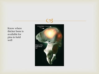 Pelvic ex fix | PPTX