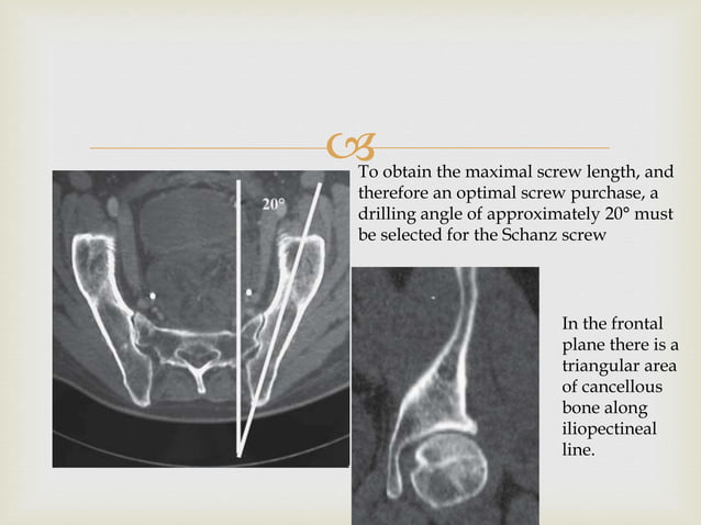Pelvic ex fix | PPTX | First Aid | Injuries