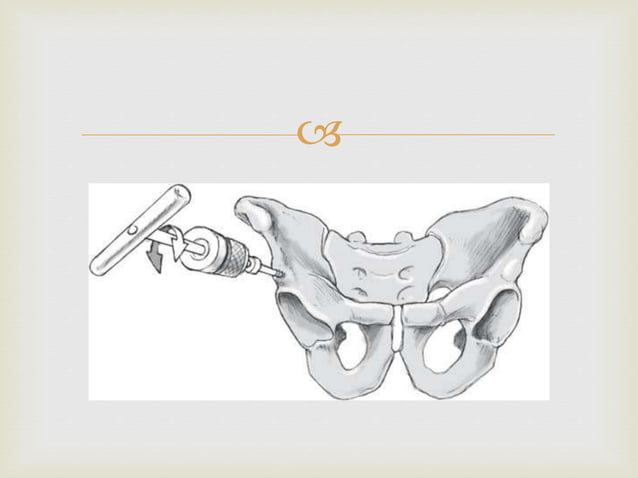 Pelvic ex fix | PPTX | First Aid | Injuries