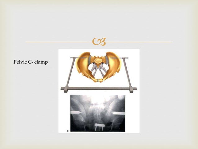 Pelvic ex fix | PPTX | First Aid | Injuries