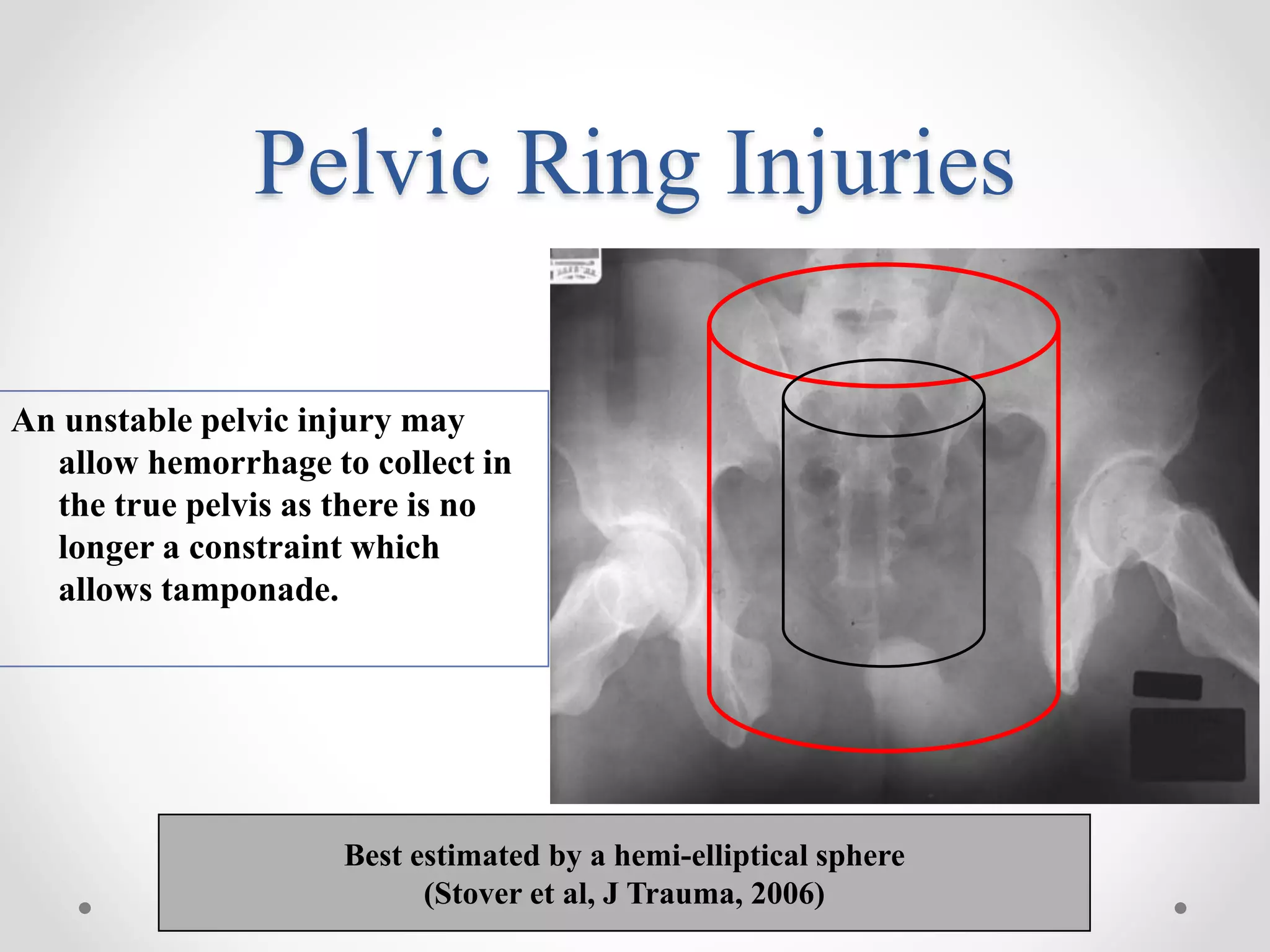 Pelvic ext | PPTX