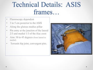 Pelvic ext | PPTX