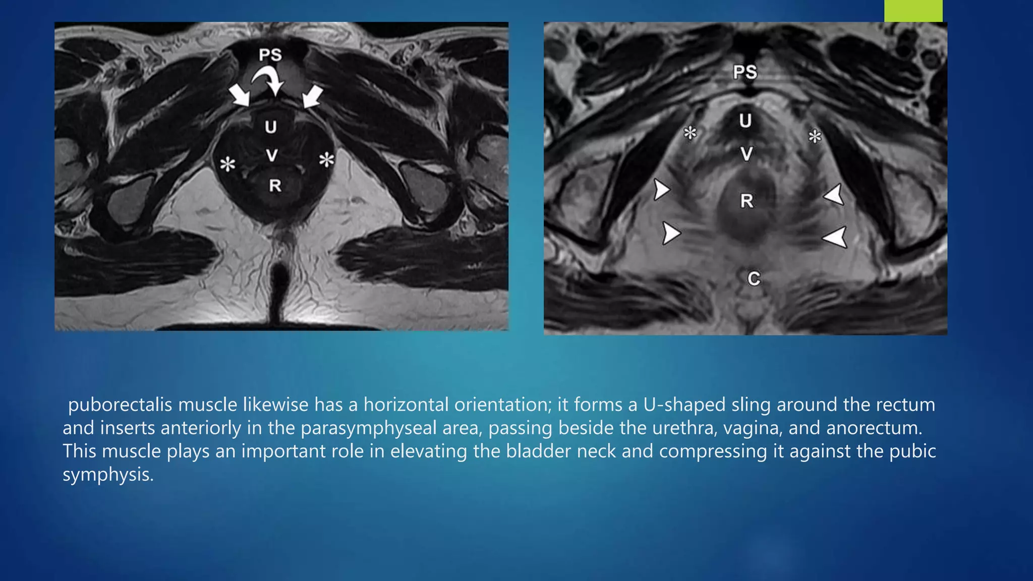 MR BASED IMAGING OF FEMALE PELVIC FLOOR | PPTX