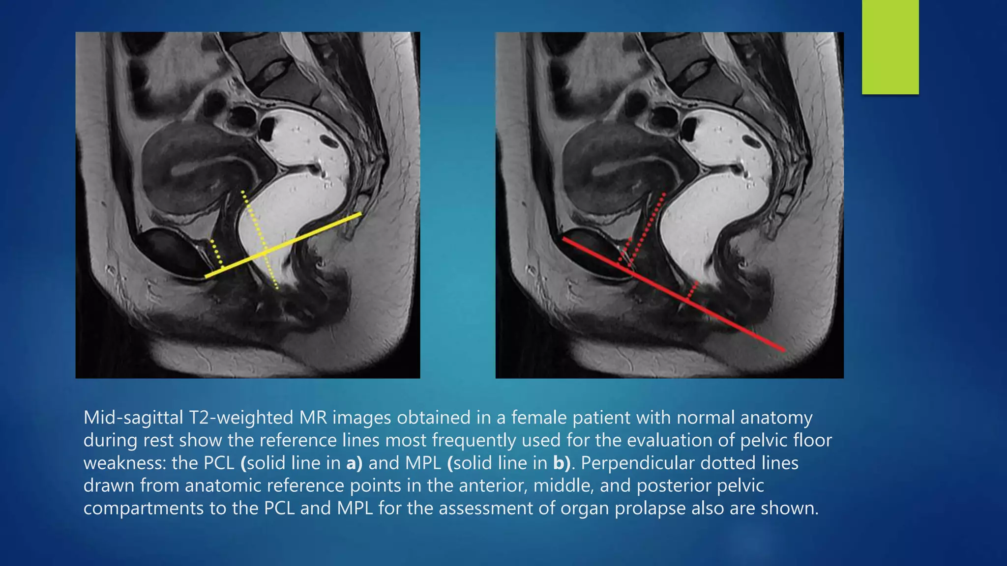 MR BASED IMAGING OF FEMALE PELVIC FLOOR | PPTX