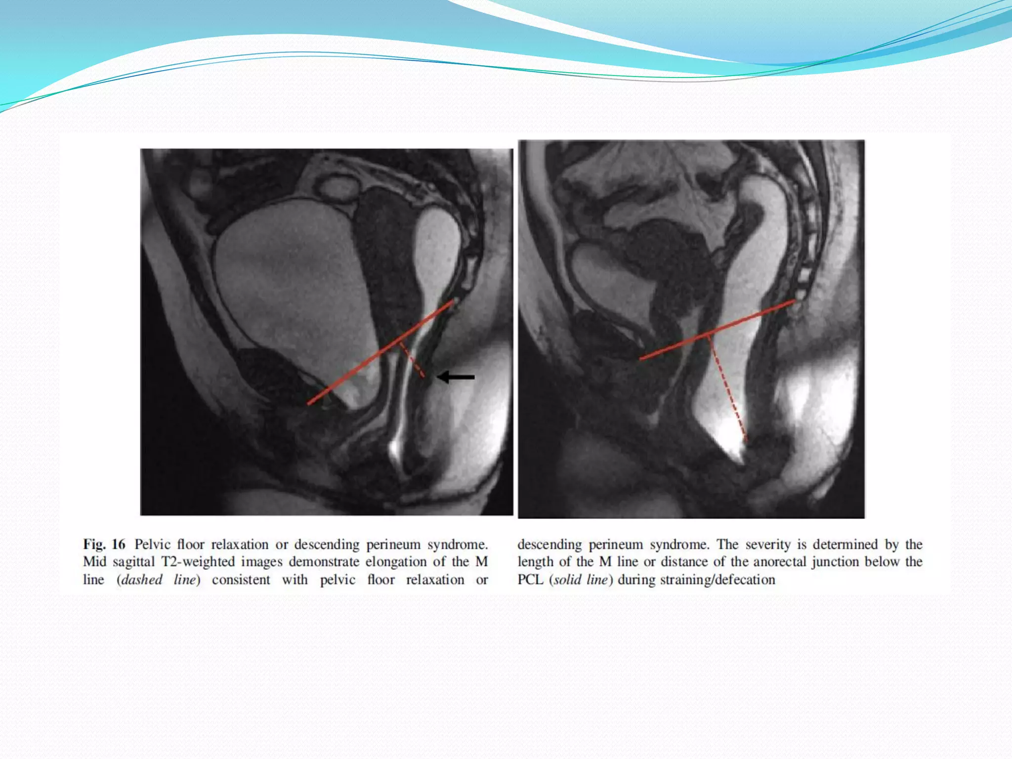 Female pelvic floor dysfunction MRI | PDF