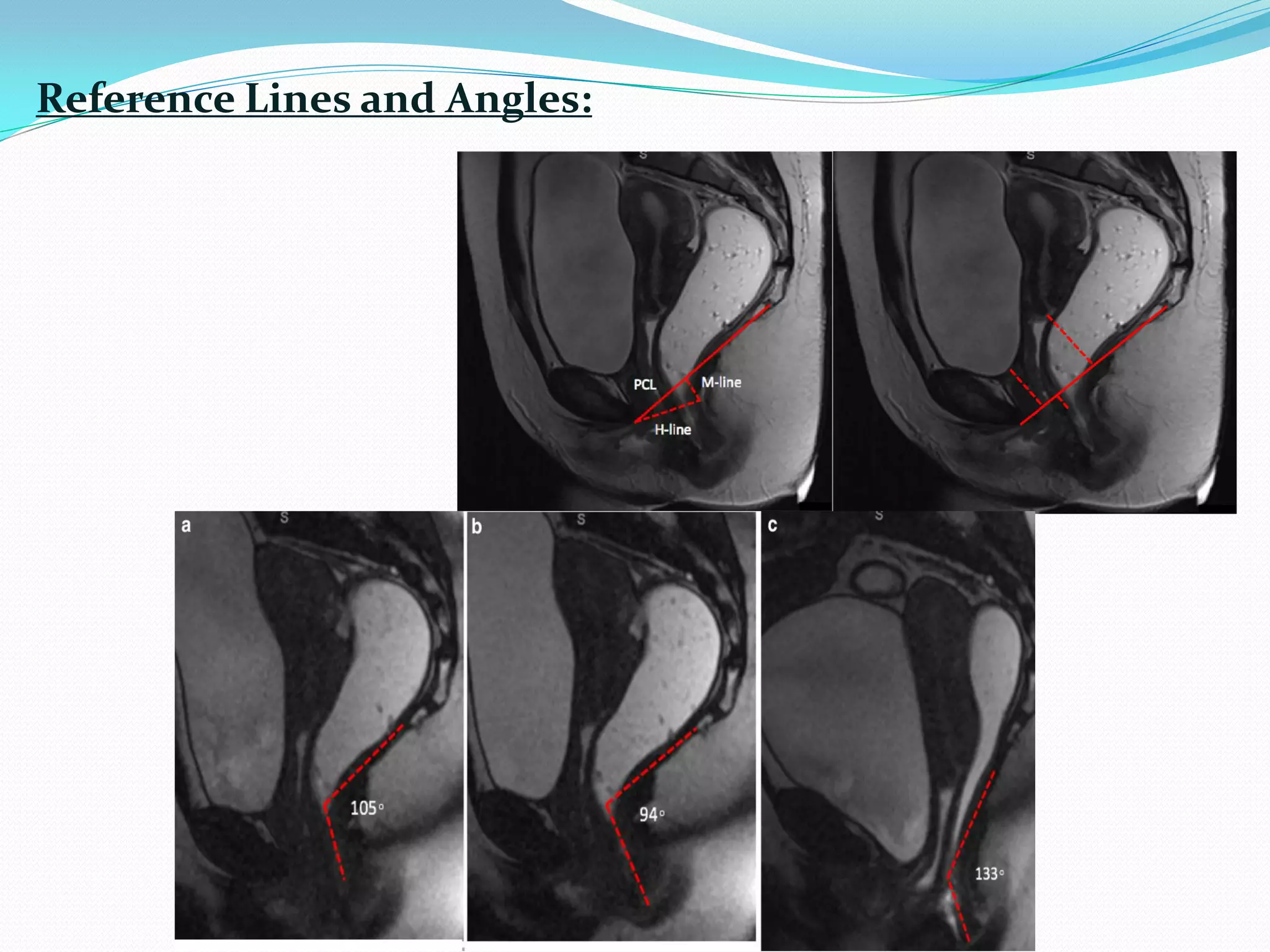 Female pelvic floor dysfunction MRI | PDF
