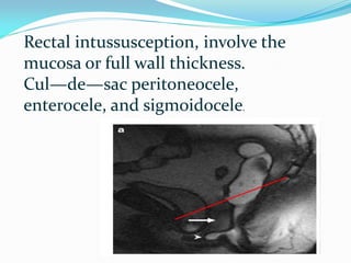 Female pelvic floor dysfunction MRI | PDF