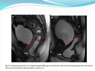 Female pelvic floor dysfunction MRI | PDF