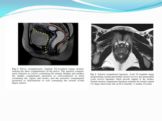 Female pelvic floor dysfunction MRI | PDF