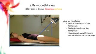 Pelvic Fracture | PPTX