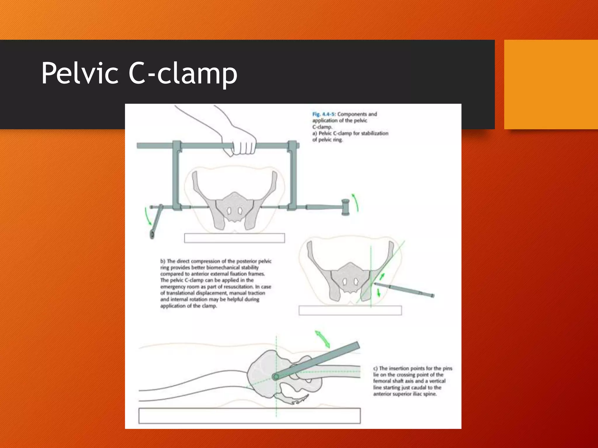 - Pelvic Fracture.pptx | Death, Injury, or Military Conflict ...