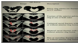 pelvic fracture .pptx