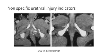 Pelvic fracture and PFUDD.pptx