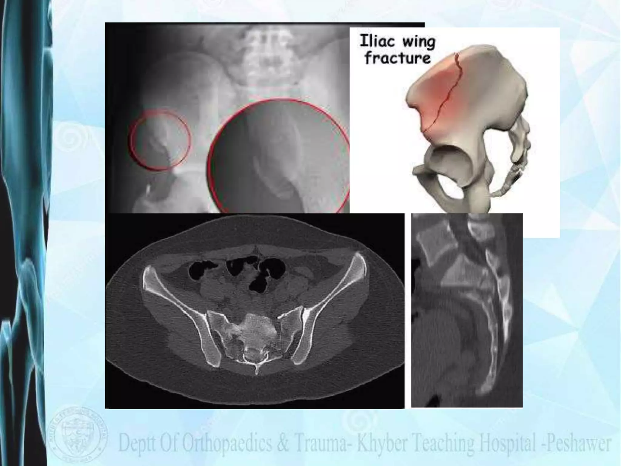 Pelvic fracture classification | PPTX
