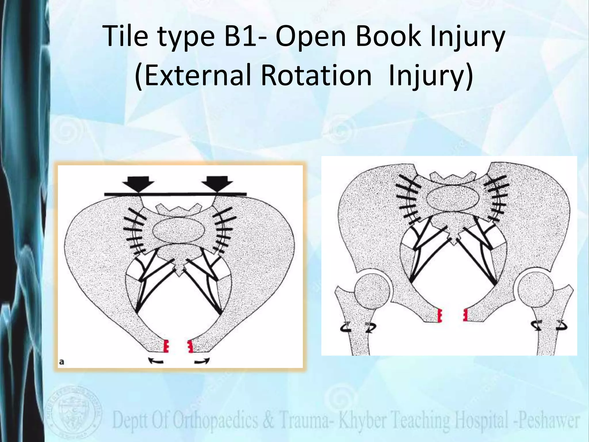 Pelvic fracture classification | PPTX