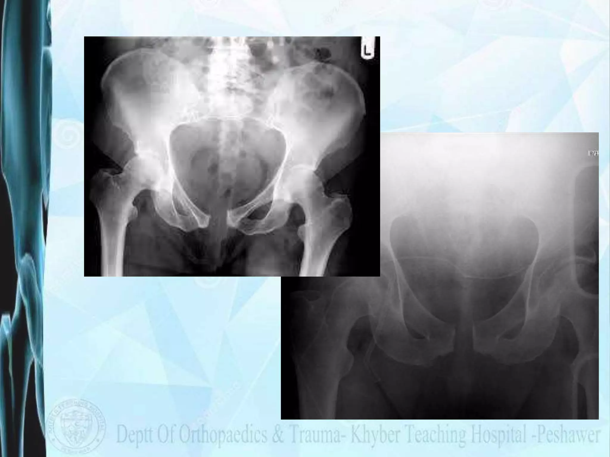 Pelvic fracture classification | PPTX