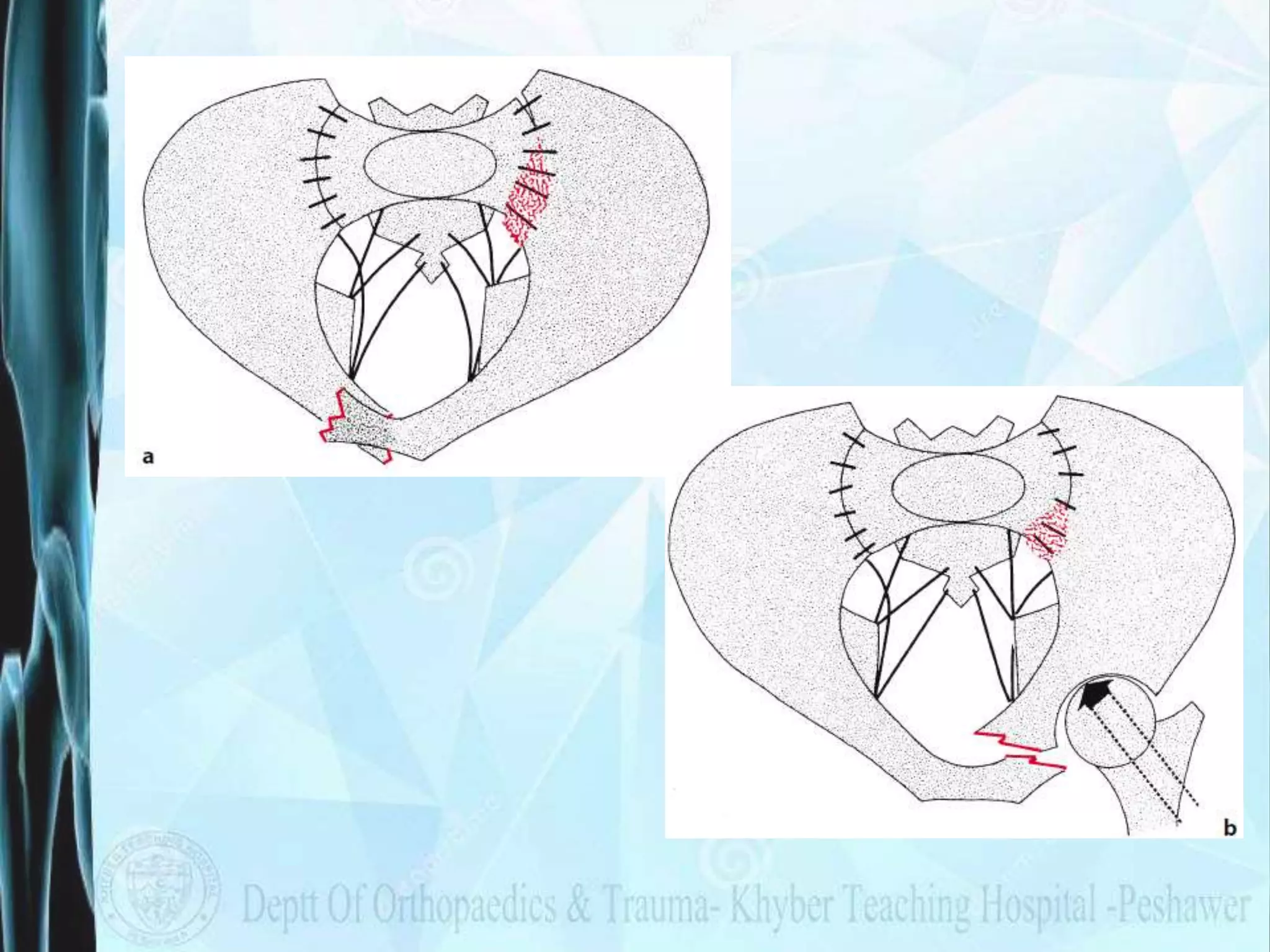 Pelvic fracture classification | PPTX
