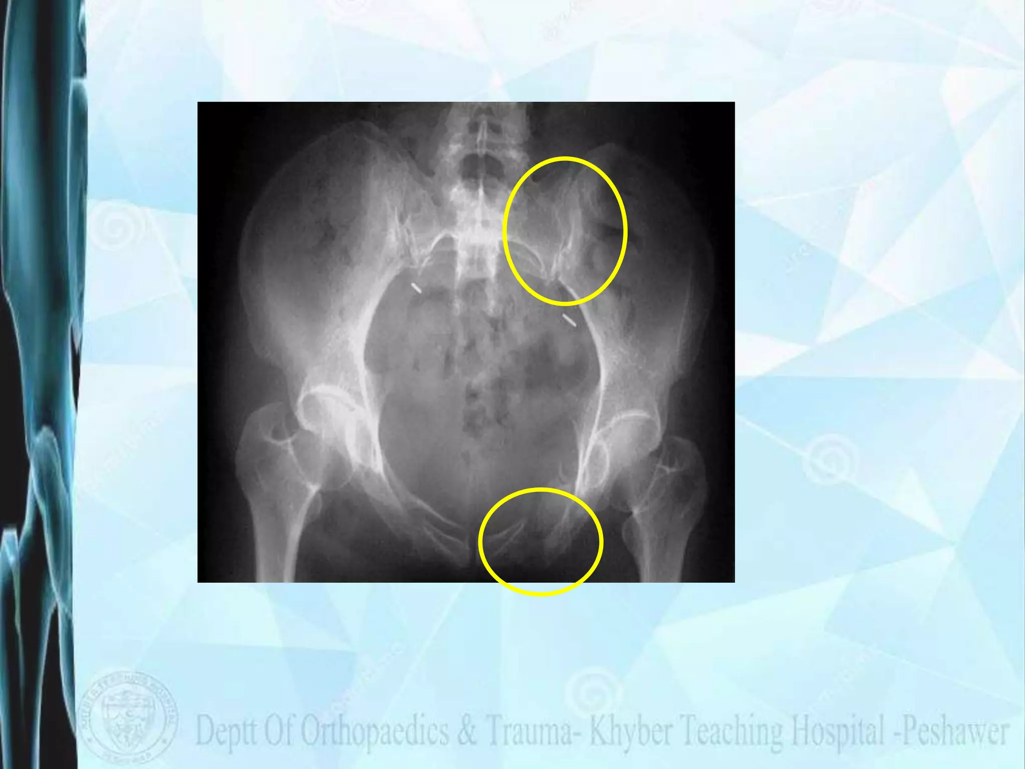 Pelvic fracture classification | PPTX