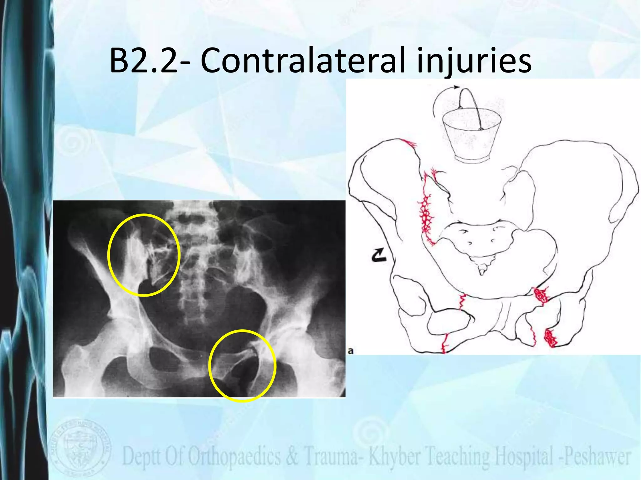 Pelvic fracture classification | PPTX