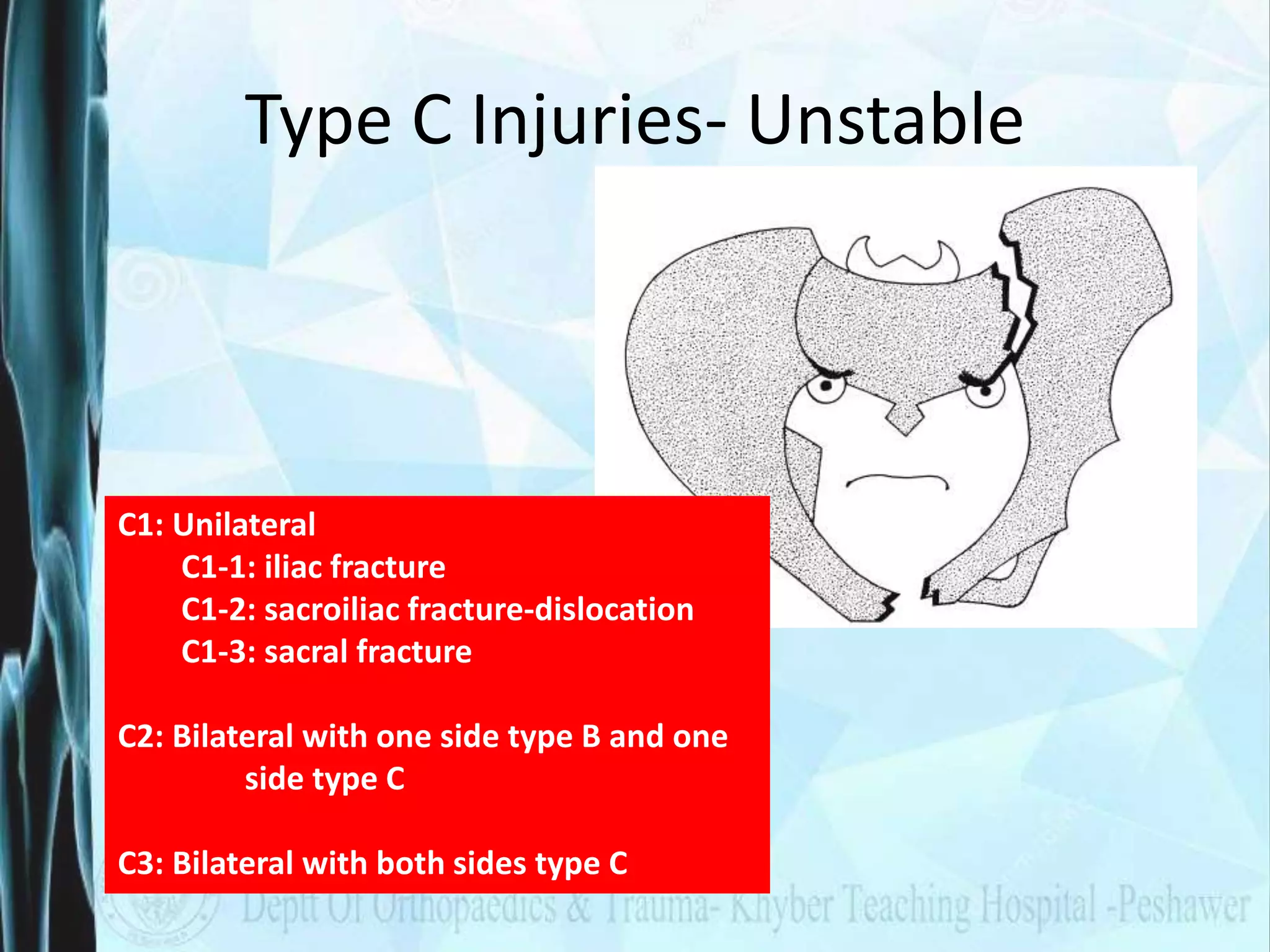 Pelvic fracture classification | PPTX