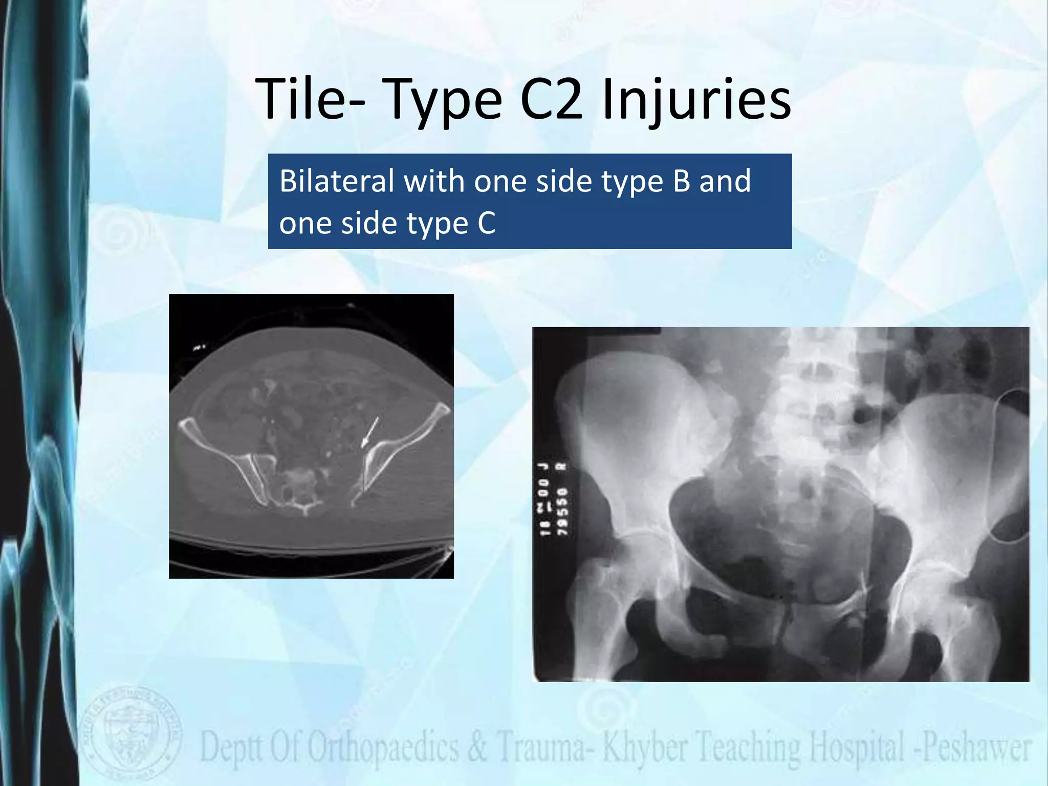Pelvic fracture classification | PPTX