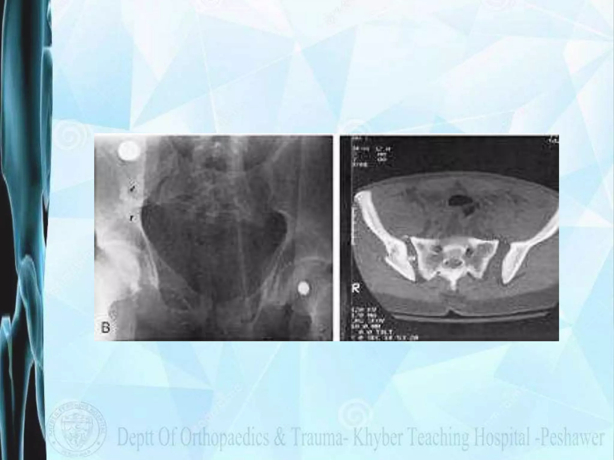Pelvic fracture classification | PPTX