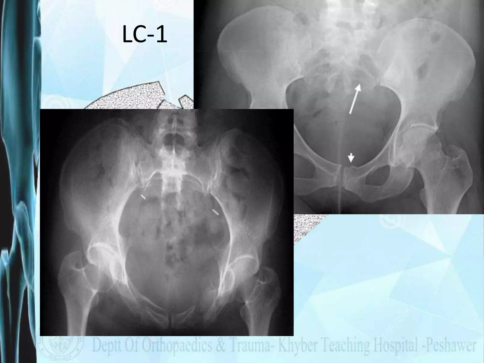 Pelvic fracture classification | PPTX