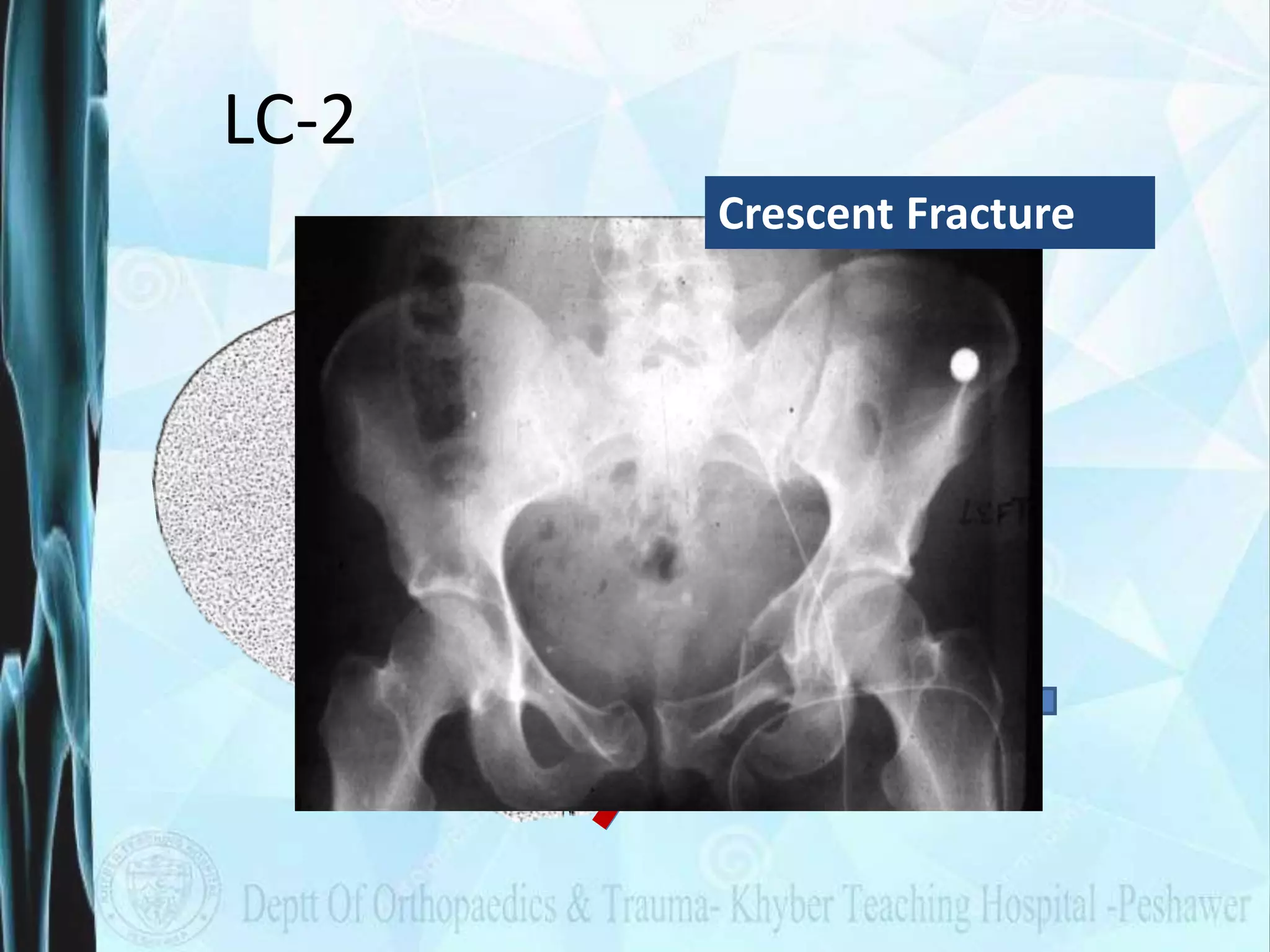 Pelvic fracture classification | PPTX