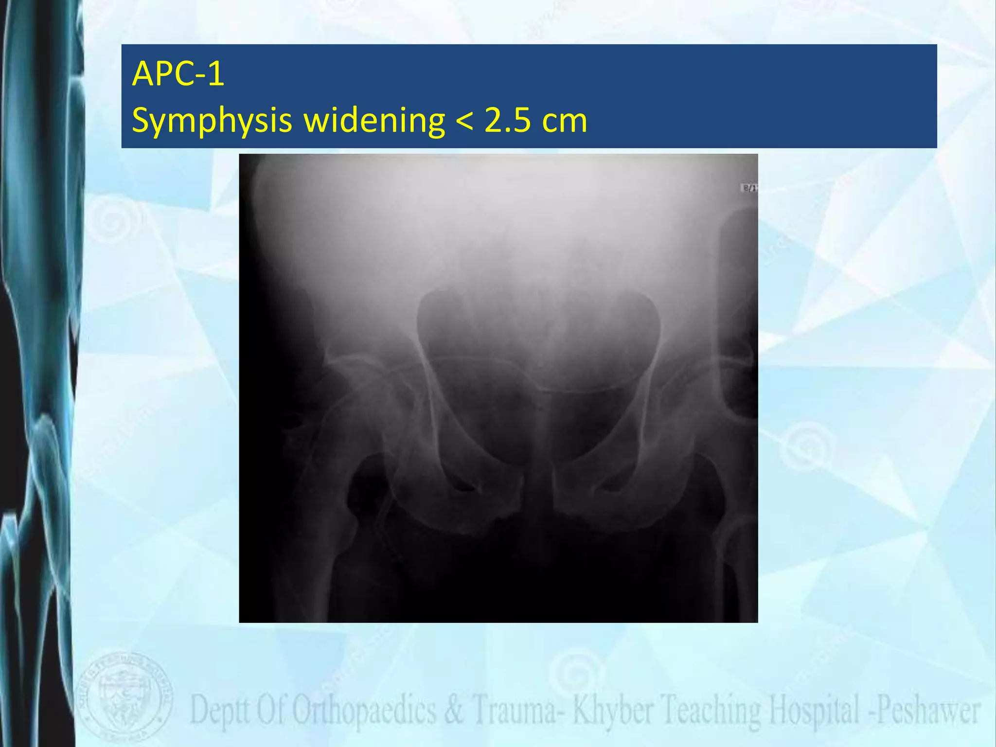 Pelvic fracture classification | PPTX
