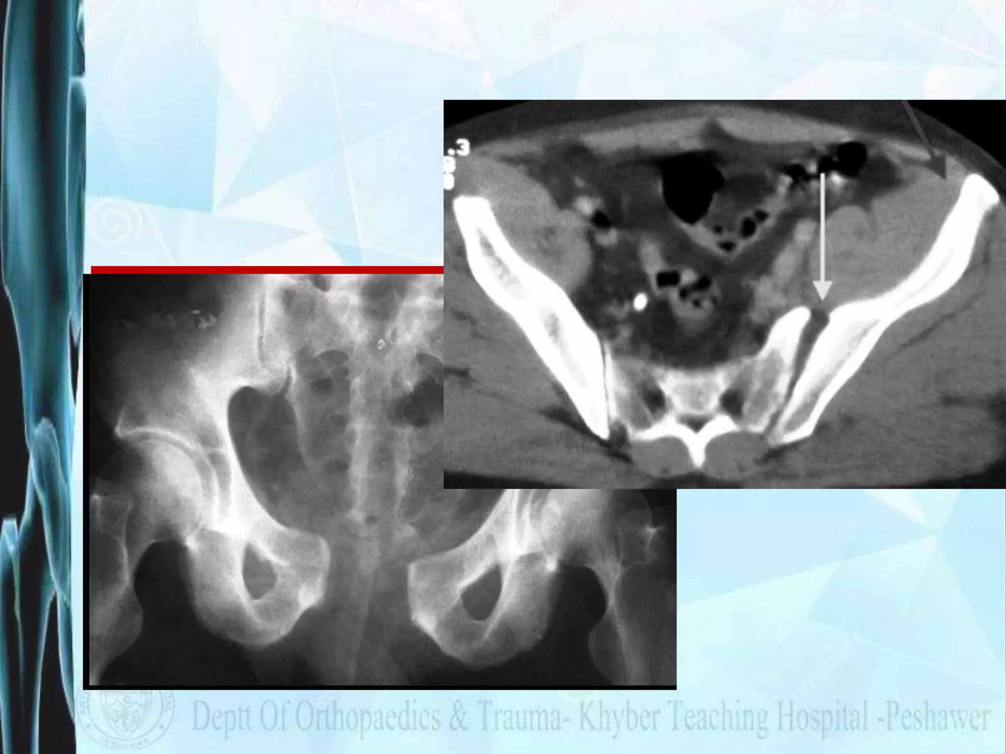 Pelvic fracture classification | PPTX